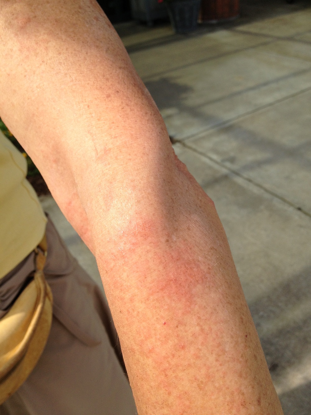 Dermatitis – Passionvine | Walter Reeves: The Georgia Gardener